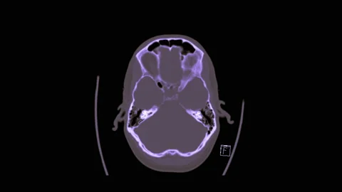 Brain CT Scan top view CAT scan x-ray. B... | Stock Video | Pond5