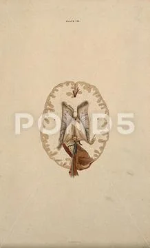 Brain: dissection showing the lateral ventricles and mid-brain ...