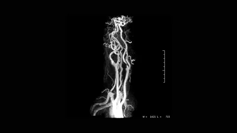 Brain MRI Angiography (Magnetic Resonanc... | Stock Video | Pond5