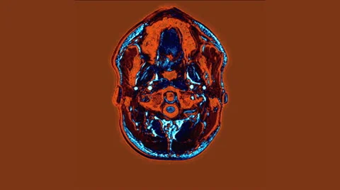 Brain MRI, axial view | Stock Video | Pond5