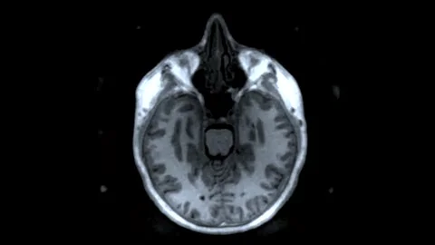 Brain MRI scan visualisation animation. | Stock Video | Pond5