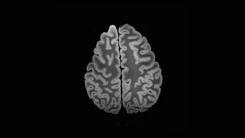Brain MRI scan visualisation animation. | Stock Video | Pond5