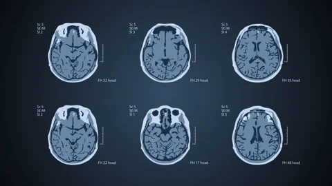 Brain MRT scan. 6 views on one screen. 4... | Stock Video | Pond5
