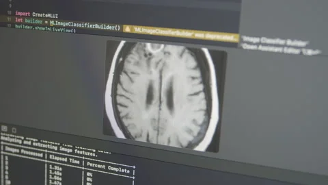 Brain Tumor MRI Dataset Analysis Deep Le... | Stock Video | Pond5