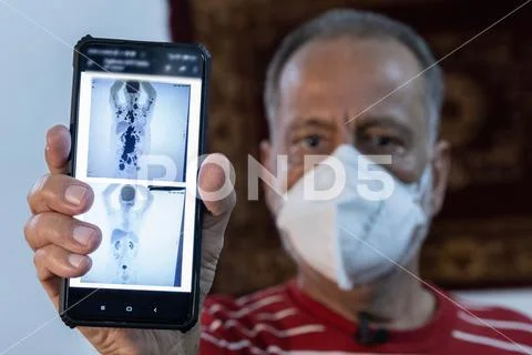 Brazilian man undergoes cancer treatment as part of CAR-T cell therapy ...