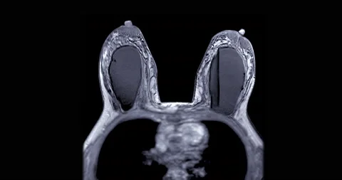 Breast Imaging Stock Footage ~ Royalty Free Stock Videos | Pond5