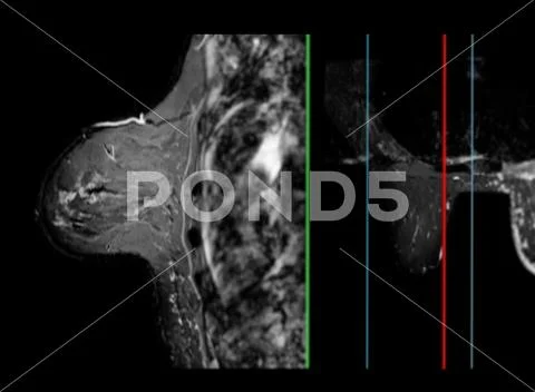 Breast MRI revealing BI-RADS 4 in women indicates suspicious findings ...