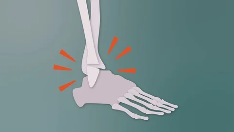 Broken Bones Stock Footage ~ Royalty Free Stock Videos | Pond5