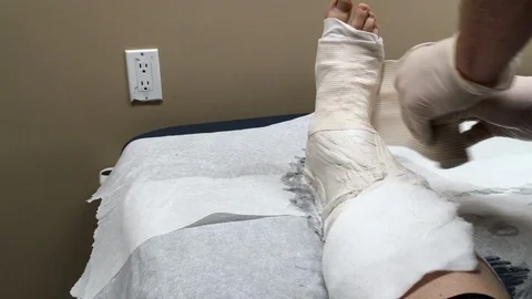 Broken ankle cast by doctor plaster band... | Stock Video | Pond5