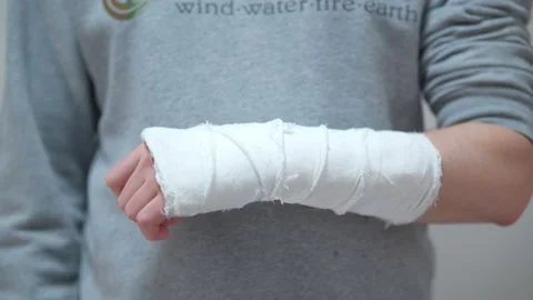 The broken arm of a man in gaps. Plaster... | Stock Video | Pond5