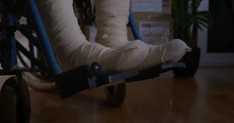 Broken bandaged legs in cast, accident, ... | Stock Video | Pond5