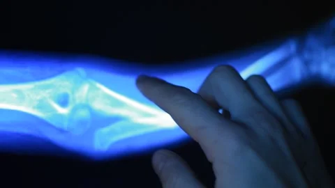 broken bone blue mri scan. doctor analys... | Stock Video | Pond5