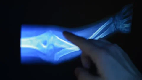 broken bone blue mri scan. doctor analys... | Stock Video | Pond5
