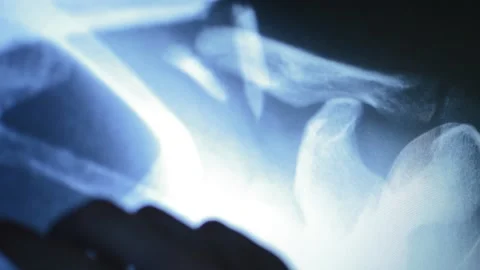 broken bone x ray mri scan. doctor monit... | Stock Video | Pond5
