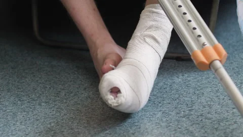 a broken leg in a cast in a bandage of a... | Stock Video | Pond5