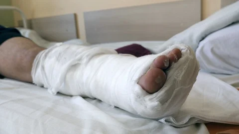 Broken leg, fracture, plaster cast, mass... | Stock Video | Pond5