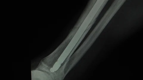 Broken Leg Stock Footage ~ Royalty Free Stock Videos | Pond5