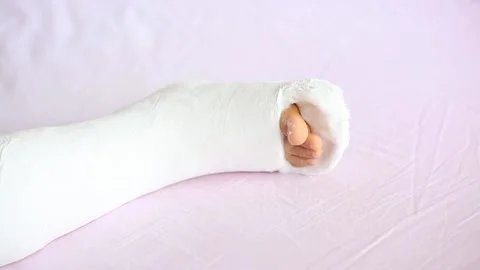 Broken Leg Cast Stock Video Footage | Royalty Free Broken Leg Cast ...