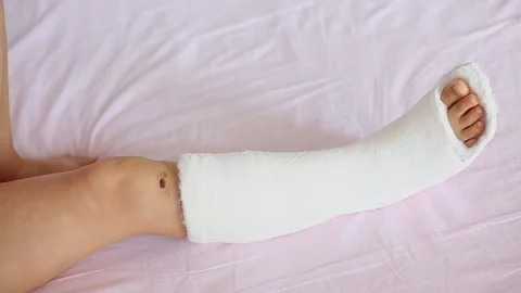 Broken leg in a orthopedic cast of an yo... | Stock Video | Pond5