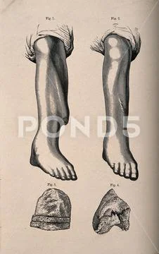 A broken leg, with the tibia bone shown protruding through the skin ...
