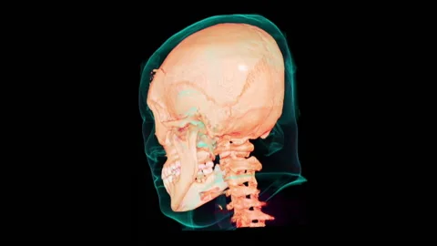 Broken skull, 3D CT scan | Stock Video | Pond5