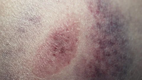 Bruise hematoma after hit on human body ... | Stock Video | Pond5
