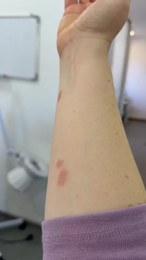 burn bite on the hand. Show me your hand... | Stock Video | Pond5