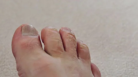 callus formation on toes, close-up of a ... | Stock Video | Pond5