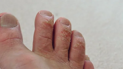 callus formation on toes, close-up of a ... | Stock Video | Pond5