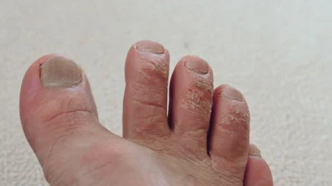 callus formation on toes, close-up of a ... | Stock Video | Pond5