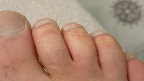 calluses and fungal disease on the toes,... | Stock Video | Pond5