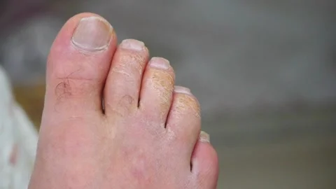 calluses and fungal disease on the toes,... | Stock Video | Pond5