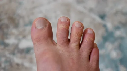 calluses and fungus on the toes, foot fu... | Stock Video | Pond5