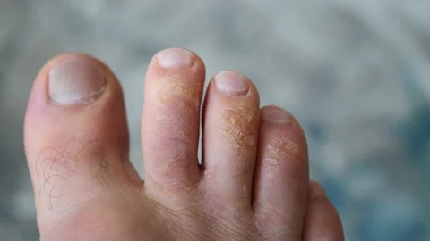 calluses and fungus on the toes, foot fu... | Stock Video | Pond5