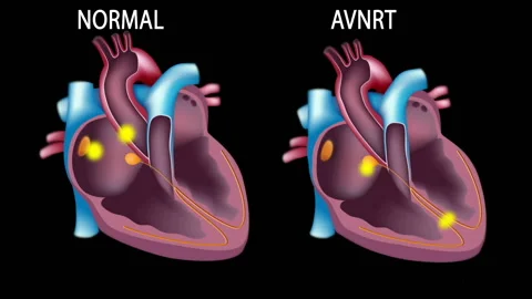 Cardiac arrhythmias: AVNRT, animation | Stock Video | Pond5