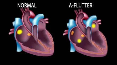 Cardiac arrhythmias: a flutter vs normal... | Stock Video | Pond5