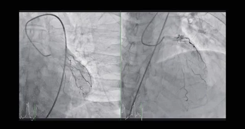Cardiac catheterization showing coronary... | Stock Video | Pond5