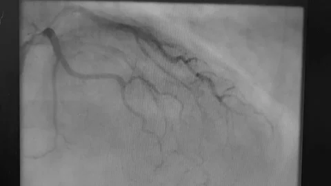 Cardiac catheterization video showing le... | Stock Video | Pond5