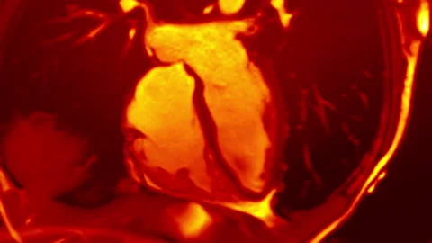Cardiac MRI of Beating Heart, Orange hea... | Stock Video | Pond5