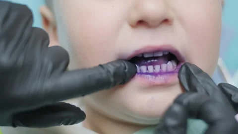 Caries Detector Dye. Diagnosis of caries... | Stock Video | Pond5