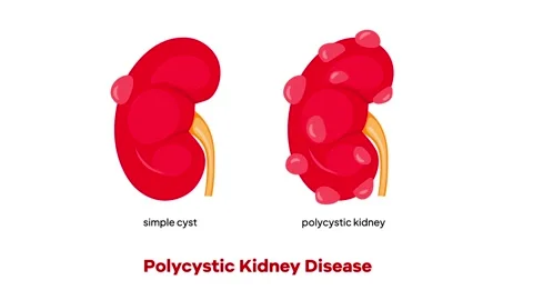 Cartoon Polycystic Kidney Disease Animat... | Stock Video | Pond5