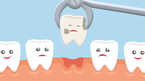 Cartoon tooth extraction dental animatio... | Stock Video | Pond5
