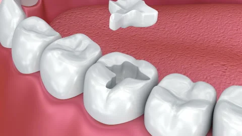 Dental Animation Stock Videos – Royalty-Free HD & 4K Videos | Pond5