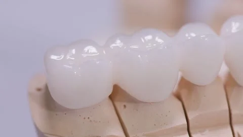 Teeth Implant Stock Video Footage | Royalty Free Teeth Implant Videos ...