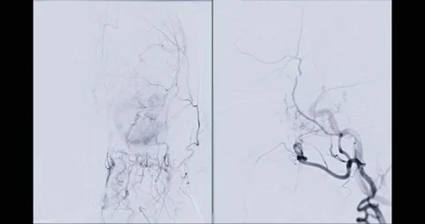 Cerebral angiogram. | Stock Video | Pond5