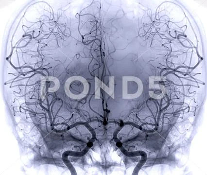 Cerebral angiography image from Fluoroscopy in intervention radiology ...