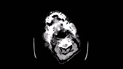 Contusion Injury Stock Videos – Royalty-Free HD & 4K Videos