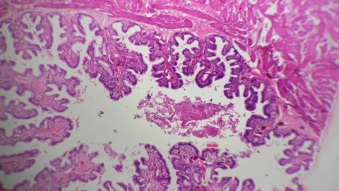 Inflammation Cervix Stock Videos – Royalty-Free HD & 4K Videos | Pond5