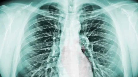 Chest x-ray and radiation. (loop ready f... | Stock Video | Pond5