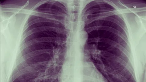 Chest x-ray human anatomy rib cage. Lung... | Stock Video | Pond5